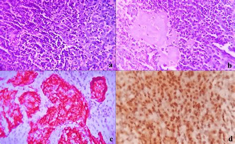 A Ales Two Populations Of Cells With Nests Of Small Blue Round Cells