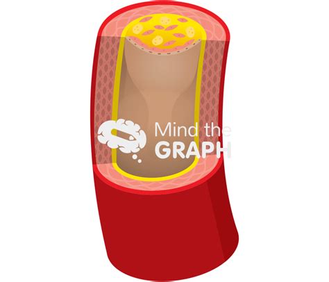 Free Atherosclerosis Plaque Icons Symbols Pictures And Images Mind
