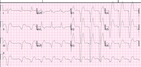 Intravenous Nitroglycerine In Stemi With Data Avoid Its Use If Giving