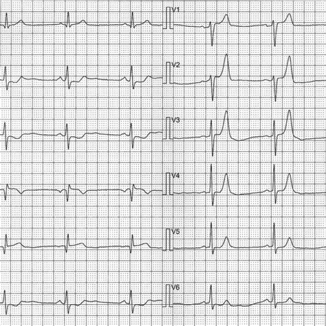 Twelve‐lead Ecg Of The Patient The Second Ecg Performed Approximately