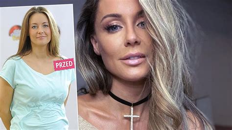 Specjalistka Wylicza Wszystkie Zabiegi Którym Poddała Się Rozenek Oto Sekrety Nieskazitelnego