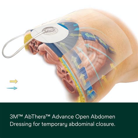3m™ Abthera™ Advance Open Abdomen Dressing