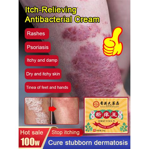 ⚡sg Hot⚡highly Effective Safe Non Irritating[itch Relieving