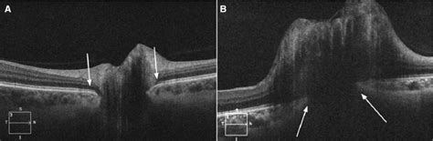 Bruchs Membrane Opening Angle Arrows In Pseudopapilloedema Appears Download Scientific