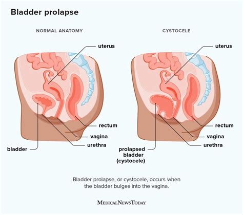 Bladder Prolapse Calko Pelvic Rehabilitation And Wellness Pelvic Health