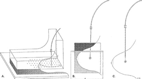 Needle Localization Oncohema Key