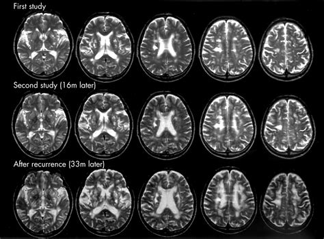 Significance Of White Matter High Intensity Lesions As A Predictor Of