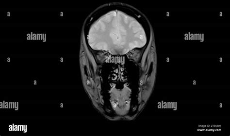 Mri Scan Of The Brain For Detect Brain Diseases Sush As Stroke Disease