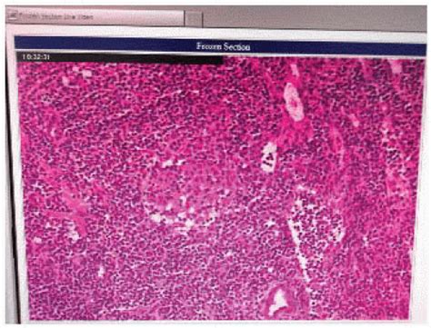Axillary Lymph Node Dissection For Melanoma Basicmedical Key