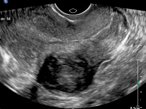 Mioma Uterino Vídeo Anatomía Definición Nwheco