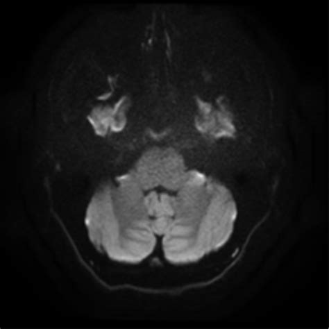 Cerebral Abscess Radiopaedia 57774 64740 Axial Dwi Nc Commons