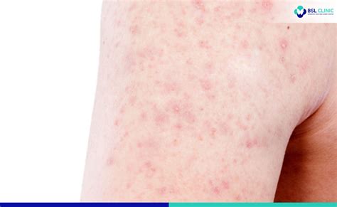 Effective Keratosis Pilaris Laser Treatment At Bsl Clinic