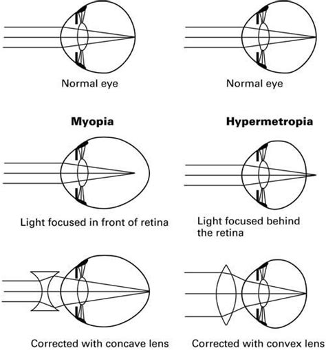 Refractive Errors And Refraction How The Eye Sees