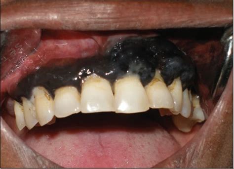 Melanoma In The Mouth 3 Effective Ways To Detect It Early