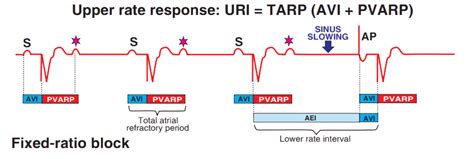 upper rate behavior of ddd pacemaker ecg book