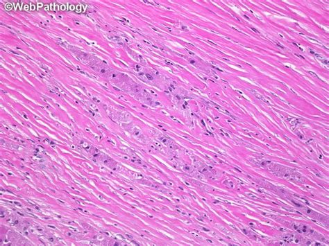 Granular Cell Tumor Desmoplasia