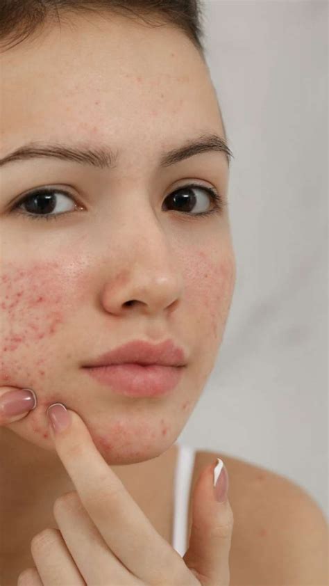 Do Not Confuse These Skin Conditions For Acne