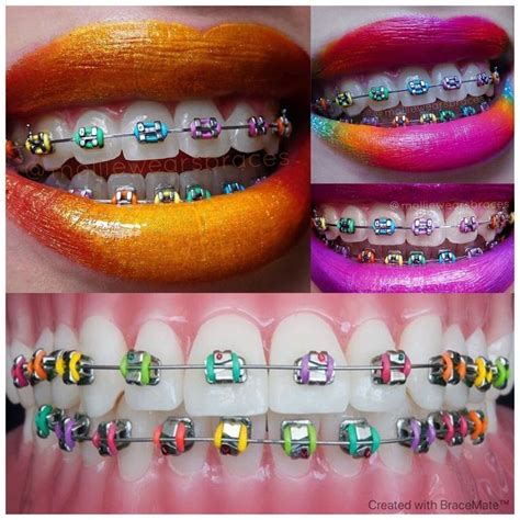 Rubber Band Colors For Braces Ideas Warehouse Of Ideas