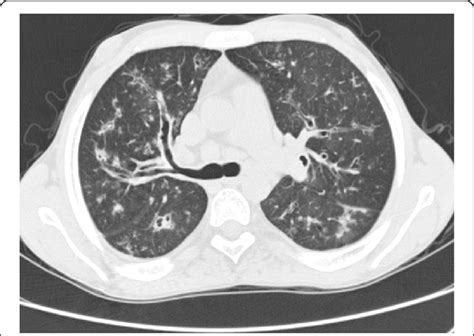 High Resolution Computed Tomography Cylindrical Bronchiectasis Mucous Download Scientific