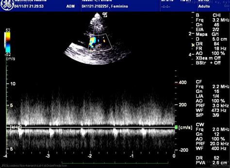 Pda Or Another Vascular Anomaly Members