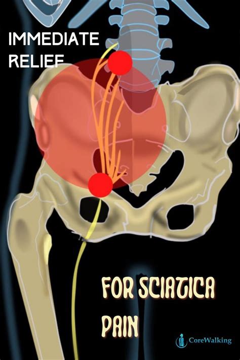 How To Fix Sciatic Nerve Tension