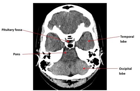 How To Interpret An Unenhanced Ct Brain Scan Part 1 Basic Principles