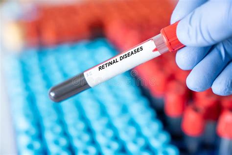 Retinal Diseases Retinal Diseases Disease Blood Test Inmedical