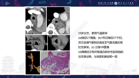 壹生资讯 今日病例成人气管支气管病变影像诊断