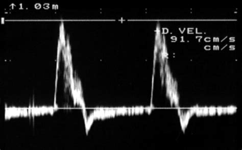 Value Of The Duplex Waveform At The Common Femoral Artery For