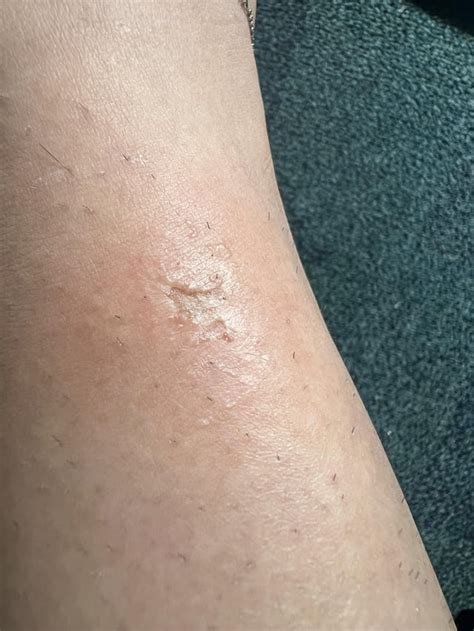 Spider Bites R Spiderbites