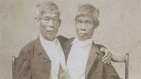 La Extraña Vida De Los Siameses Bunker El Misterio Sobre La Sexualidad Y Sus Cuerpos Conectados