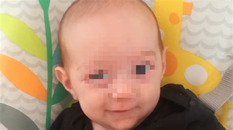 Muore Di Meningite Batterica Donati Gli Organi Della Piccola Leda