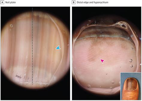Assessment Of A Predictive Scoring Model For Dermoscopy Of Subungual
