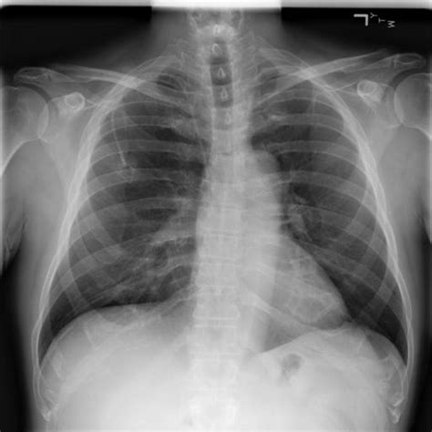 Tb Detection Classification Dataset And Pre Trained Model By Kbs