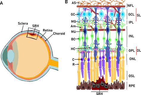 Subretinal Hemorrhage A Schematic Diagram Represents The Human Eye Download Scientific