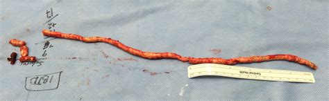 The Ilio Femoral Popliteal Remote Endarterectomy The Concept Behind Extended Remote