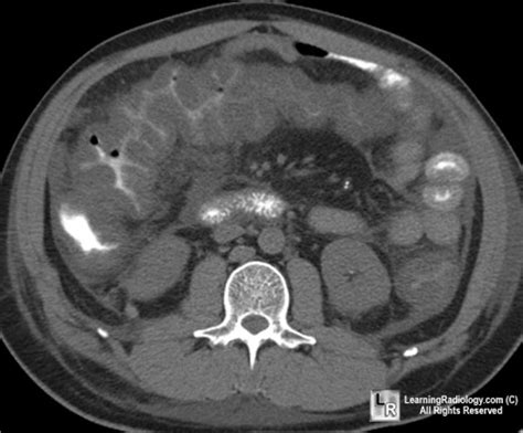Pseudomembranous Colitis X Ray