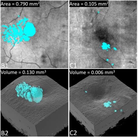 Automated Retinal Fluid Segmentation Results On Shadow Artifact