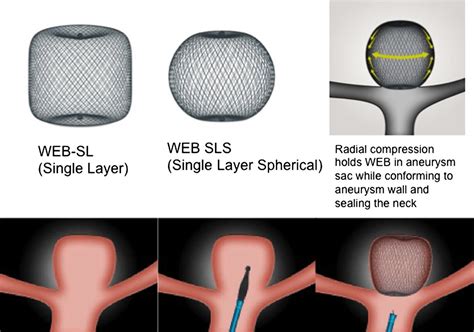 Cerebral Aneurysm Treatment Modern Neurovascular Techniques Stroke And Vascular Neurology