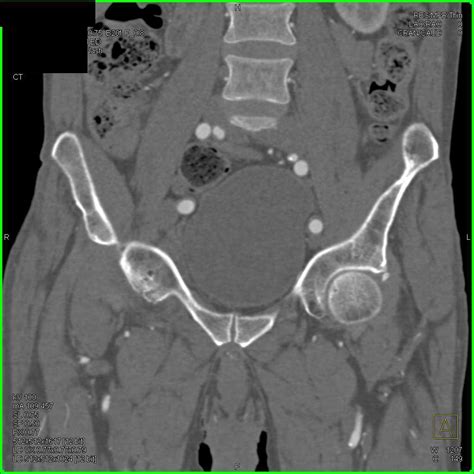 Right Hip Joint Effusion And Normal Cta Musculoskeletal Radiology