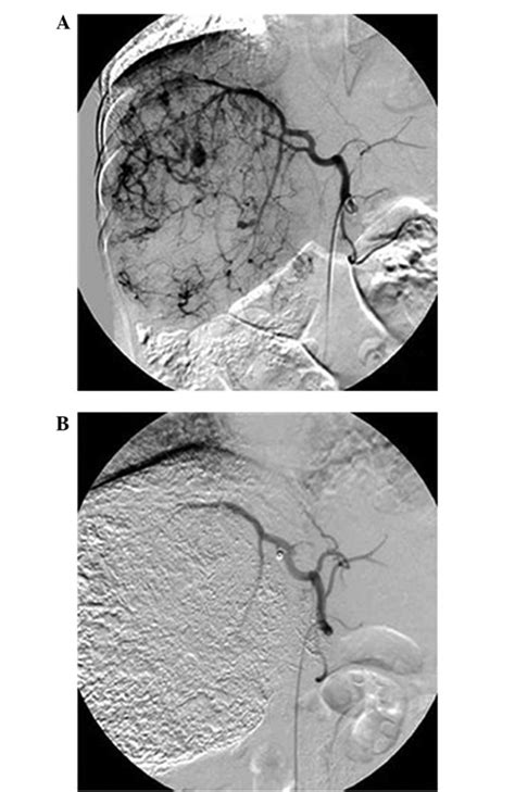 Hepatic Angiography A Pre Chemoembolization Hepatic Arteriography