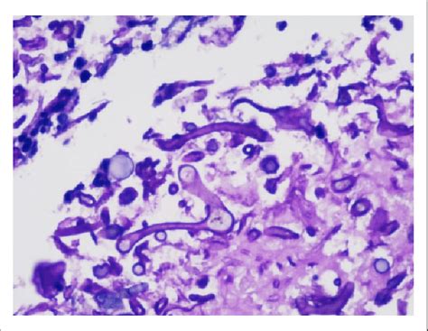 Biopsies Performed During Endoscopic Ethmoidectomy Periodic