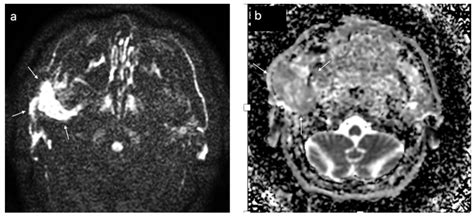Malignant Tumor Of The Left Parotid Gland White Arrows Dwi Sequences