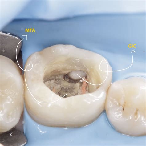 Biomimetic Composite Compositerestoration Directcomposite
