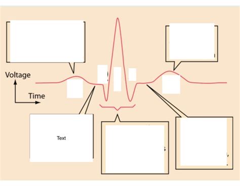 Ecg Graph Quiz