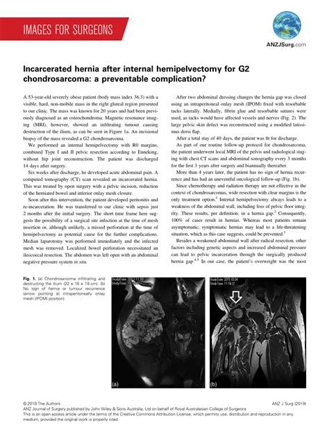Pdf Incarcerated Hernia After Internal Hemipelvectomy For G2
