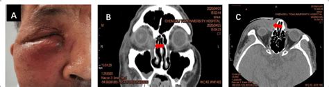 The Patients Eye Appearance And Results Of The Ct Scan Of The Sinuses