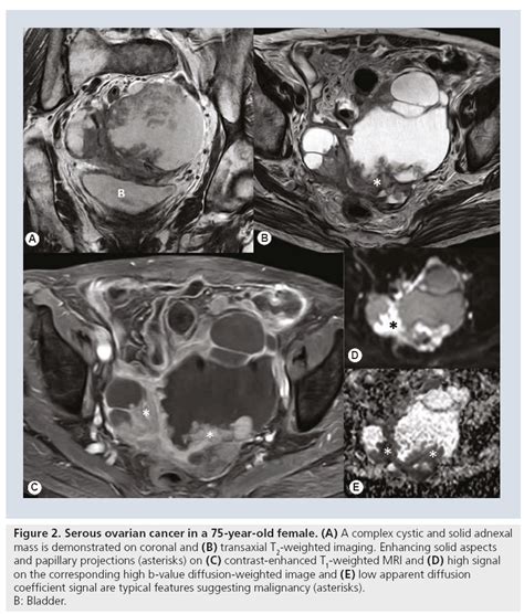 Imaging Tests For Ovarian Cancer At Gail Gaskell Blog
