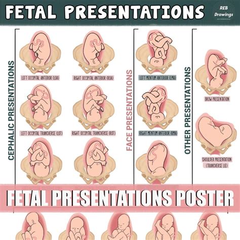 Fetal Presentations Poster Etsy