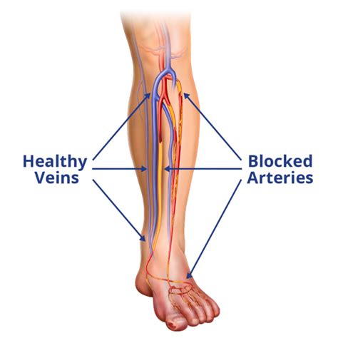 How The Limflow System Works Limflow